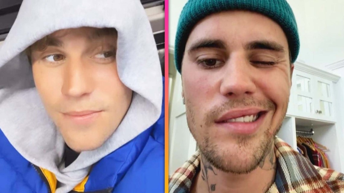 Justin Bieber Proudly Shares Facial Mobility Progress After Ramsay Hunt ...
