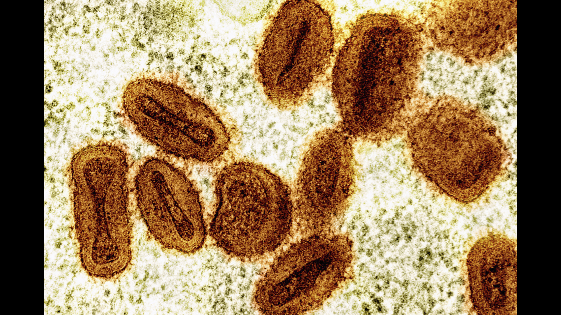 First case of new form of mpox found in United States | wkyc.com