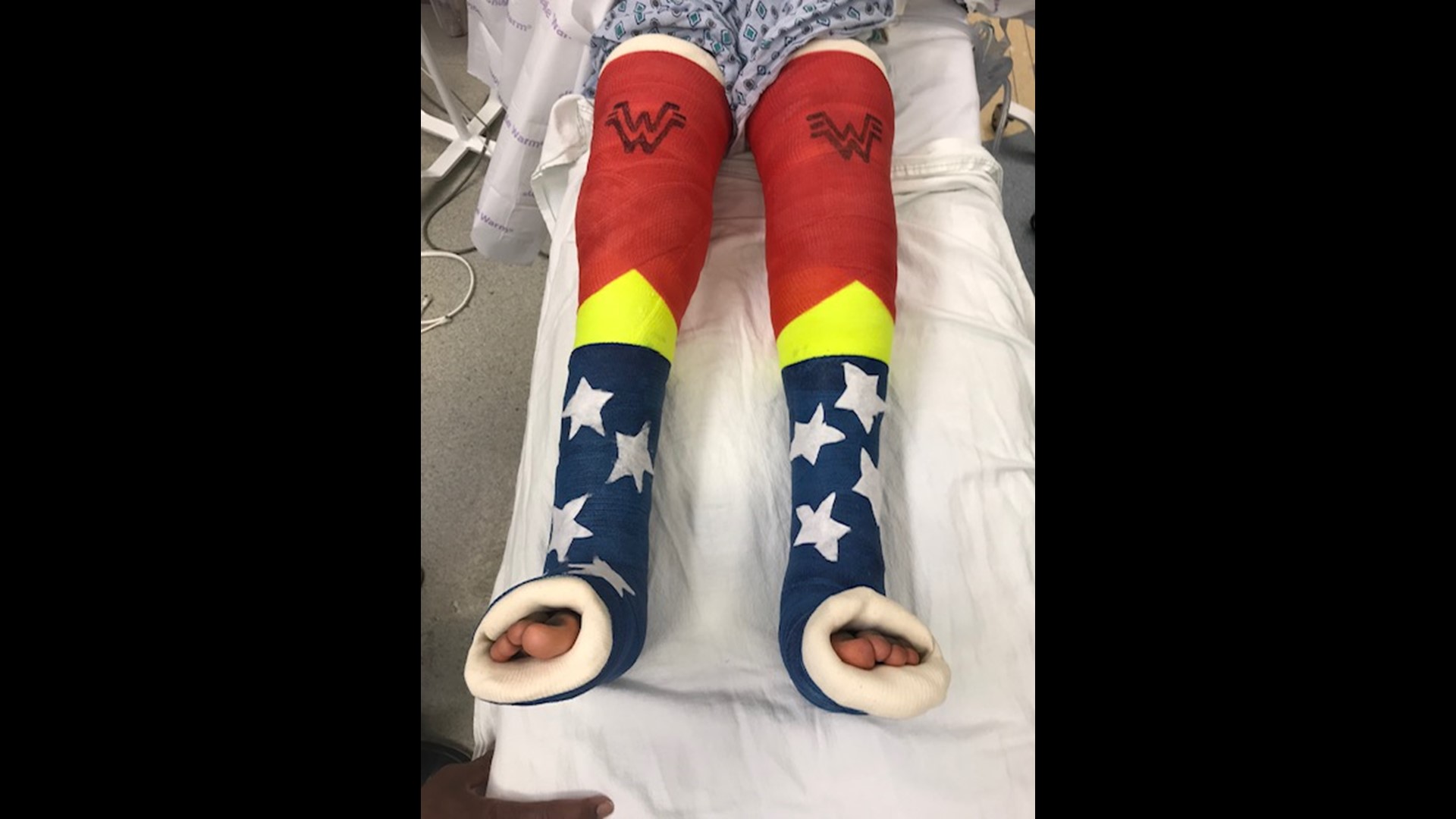 'Creative casting' sets pediatric orthopedic surgeon apart | wkyc.com