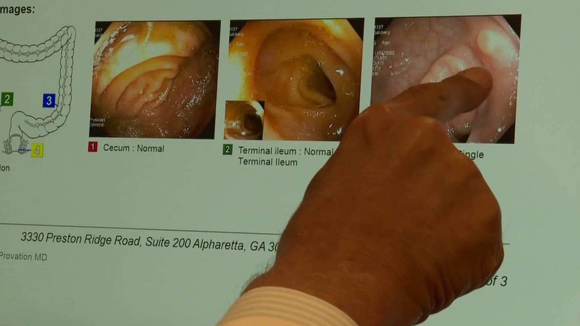 Colorectal cancer cases climb in younger adults, reversing decades of ...