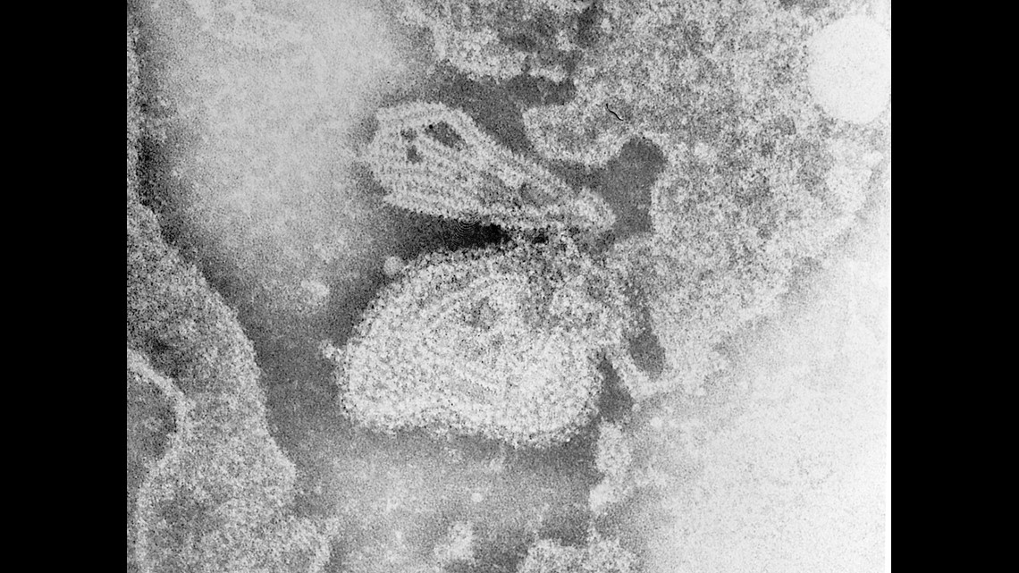 Erie County student diagnosed with mumps | wkyc.com