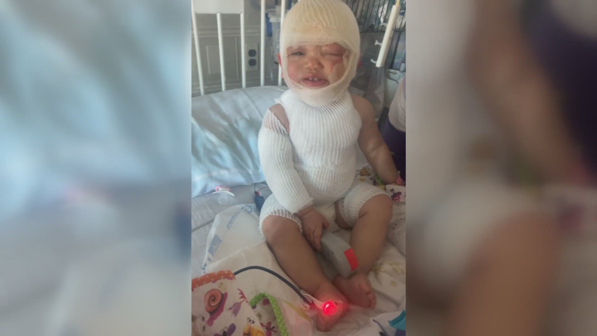 1-year-old suffers burns under babysitter's care in Akron; police charge sitter | wkyc.com