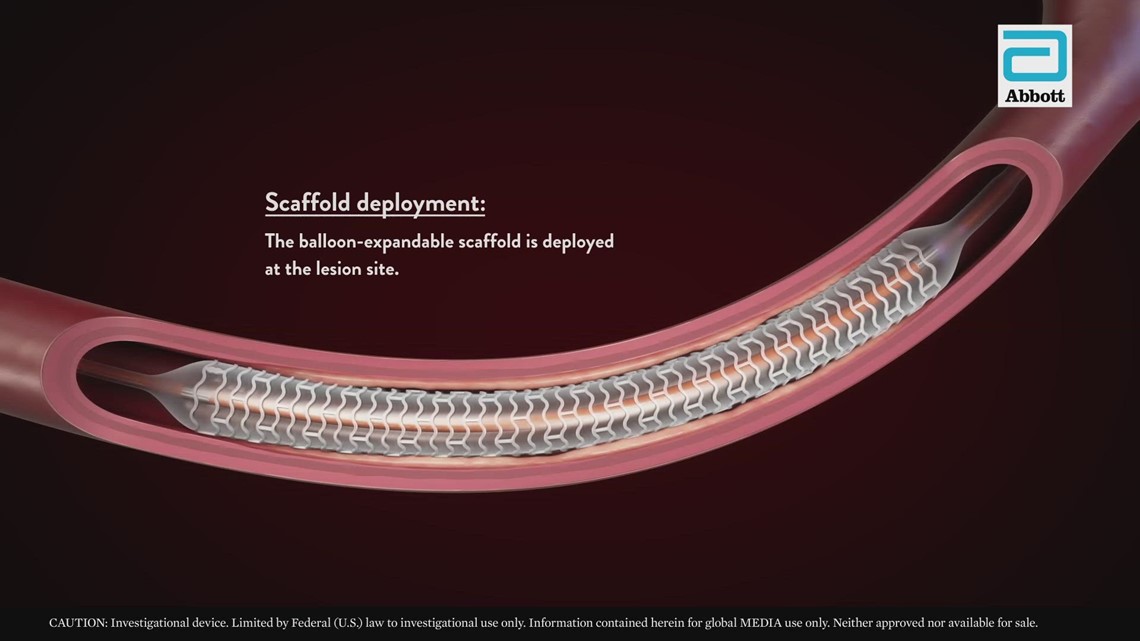 Disappearing stent shows promise and may prevent leg amputation in P.A ...