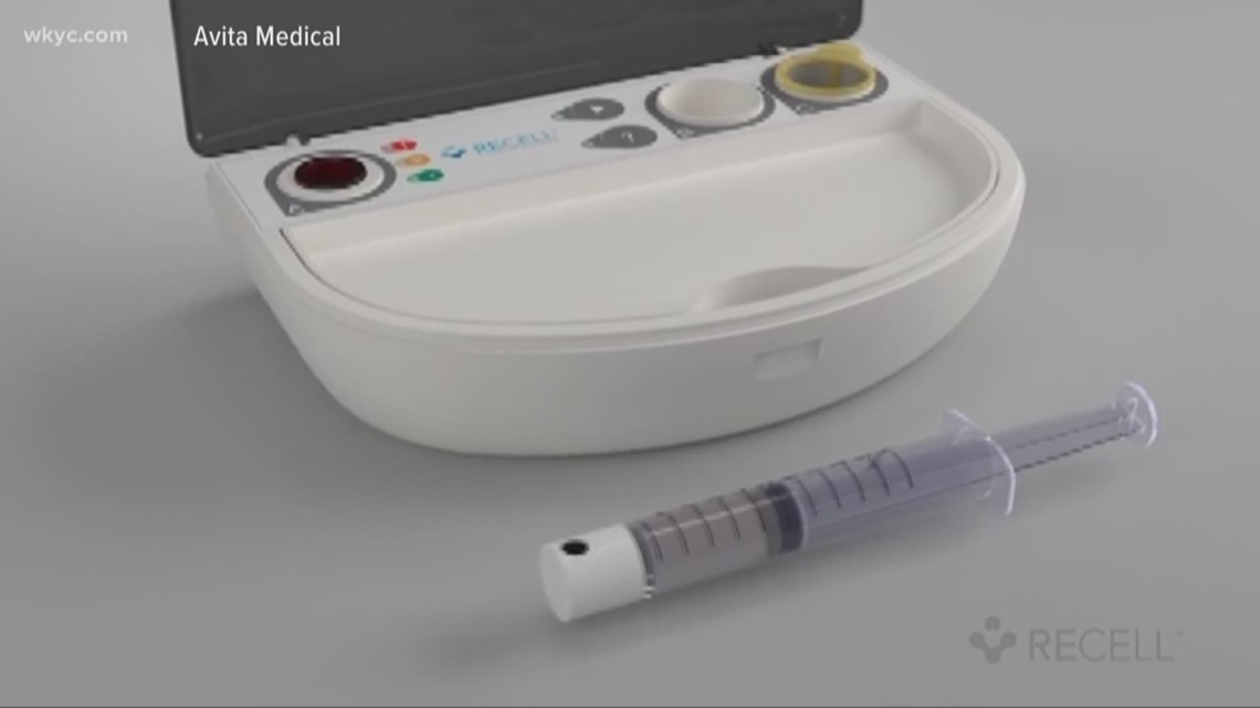 New device uses patient’s own skin cells to heal burns | wkyc.com