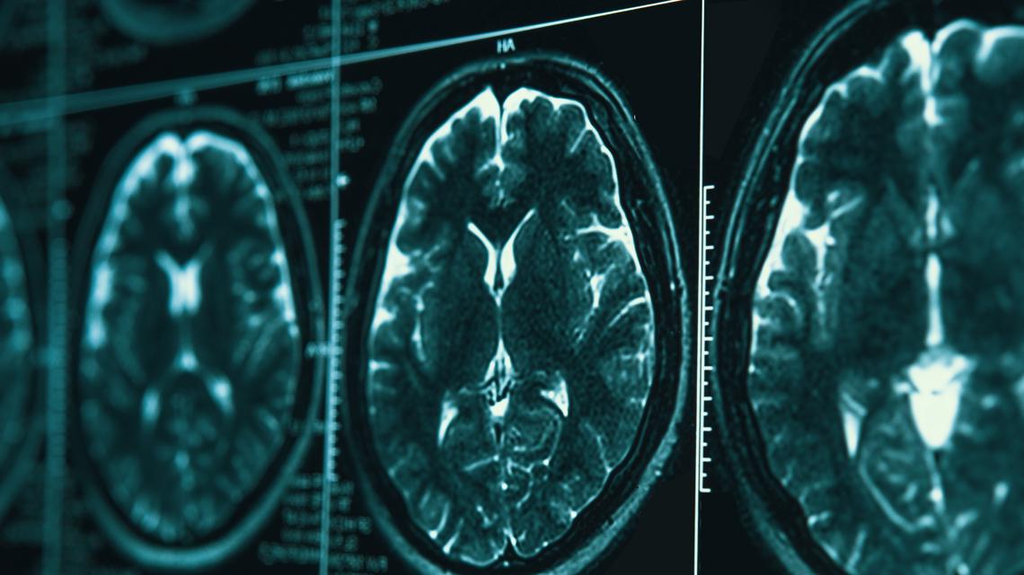 Groundbreaking study shows Alzheimer's may be reversible in advanced ...