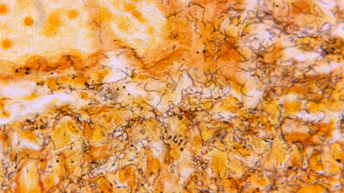 How Cleveland experts are reacting to high syphilis case numbers | wkyc.com