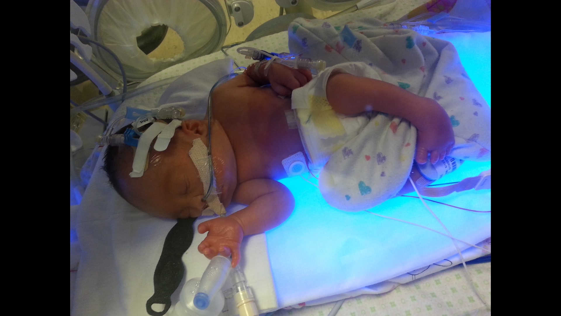 MiraCLE: 5-year-old girl survives grim prognosis while battling a birth ...