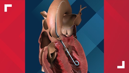 Impella device saves life of man who advocates its use | wkyc.com