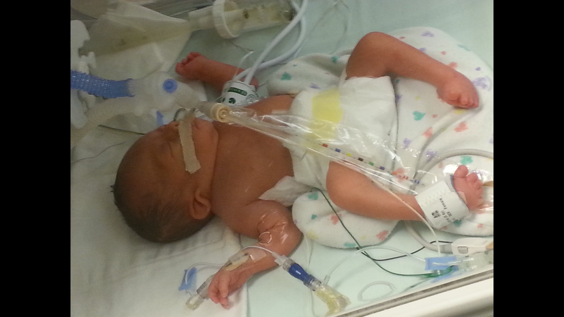 MiraCLE: 5-year-old girl survives grim prognosis while battling a birth ...