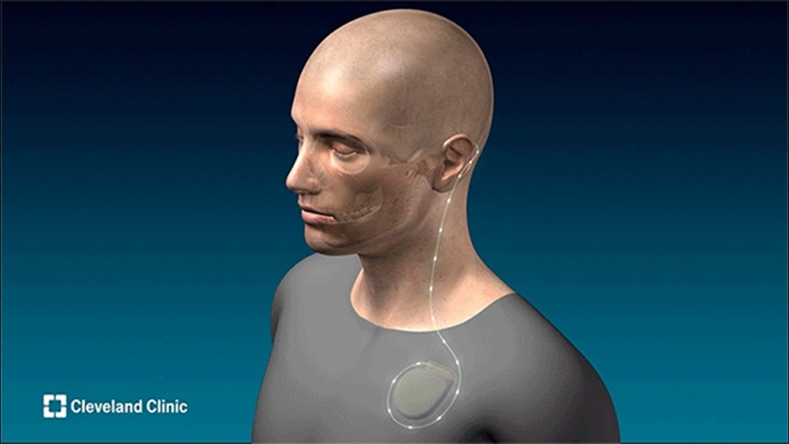 Cleveland Clinic trial for stroke patients dealing with paralysis ...