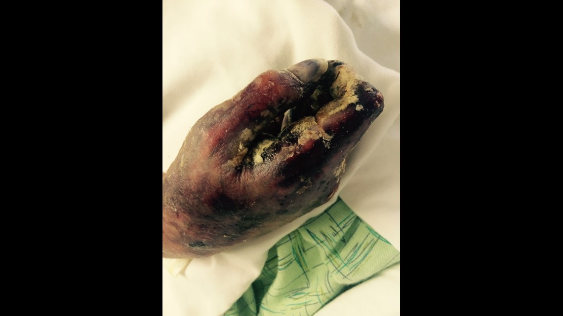 'Worst case she'd ever seen' | Another nursing home resident eaten ...